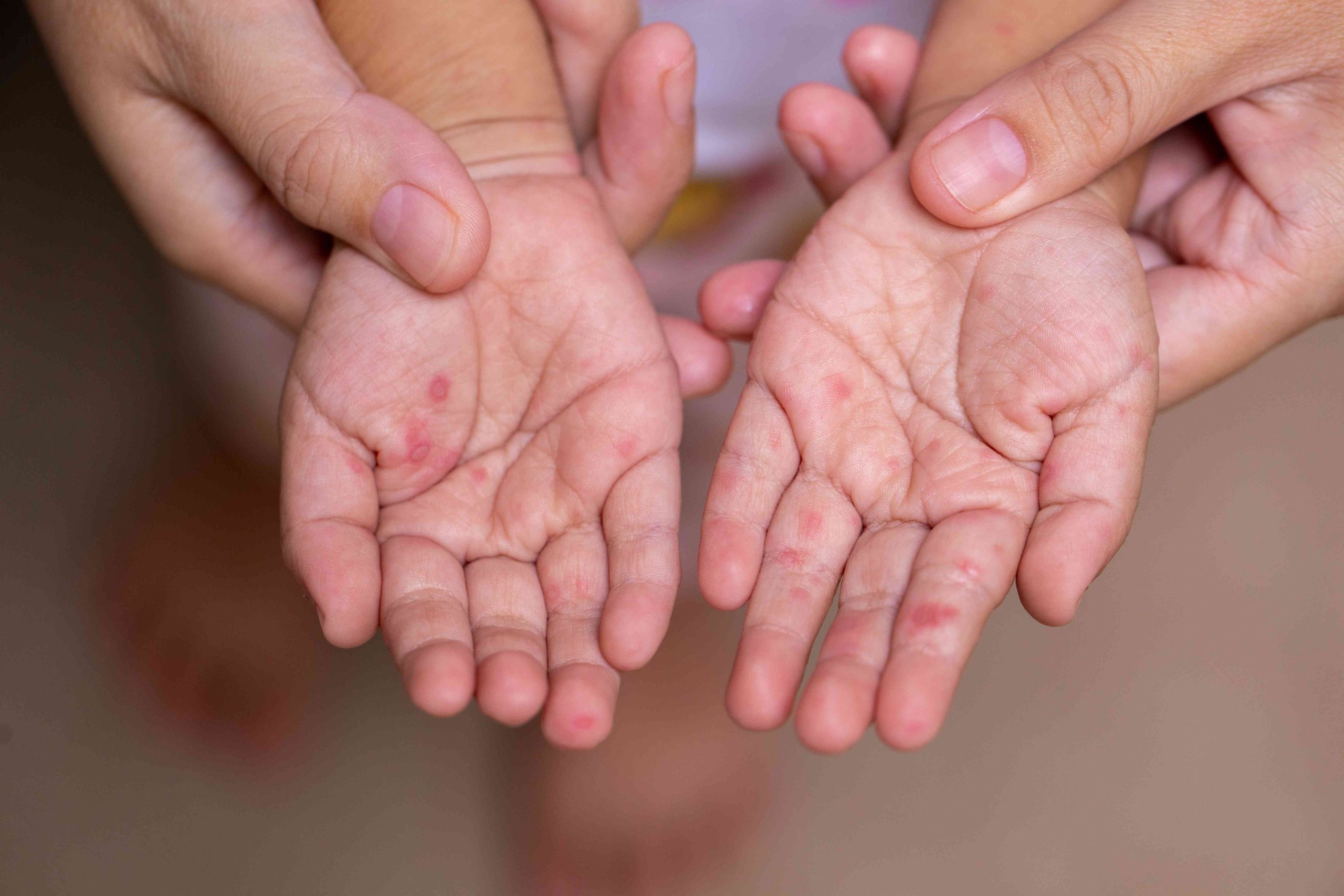Hand foot and mouth disease, an epidemic in young children ...